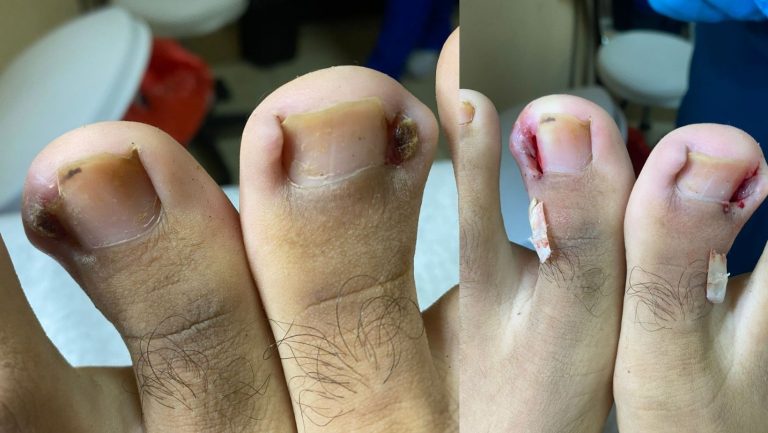 ¿Uñas encarnadas? Así tratamos las uñas encarnadas en Clínica Podal ...