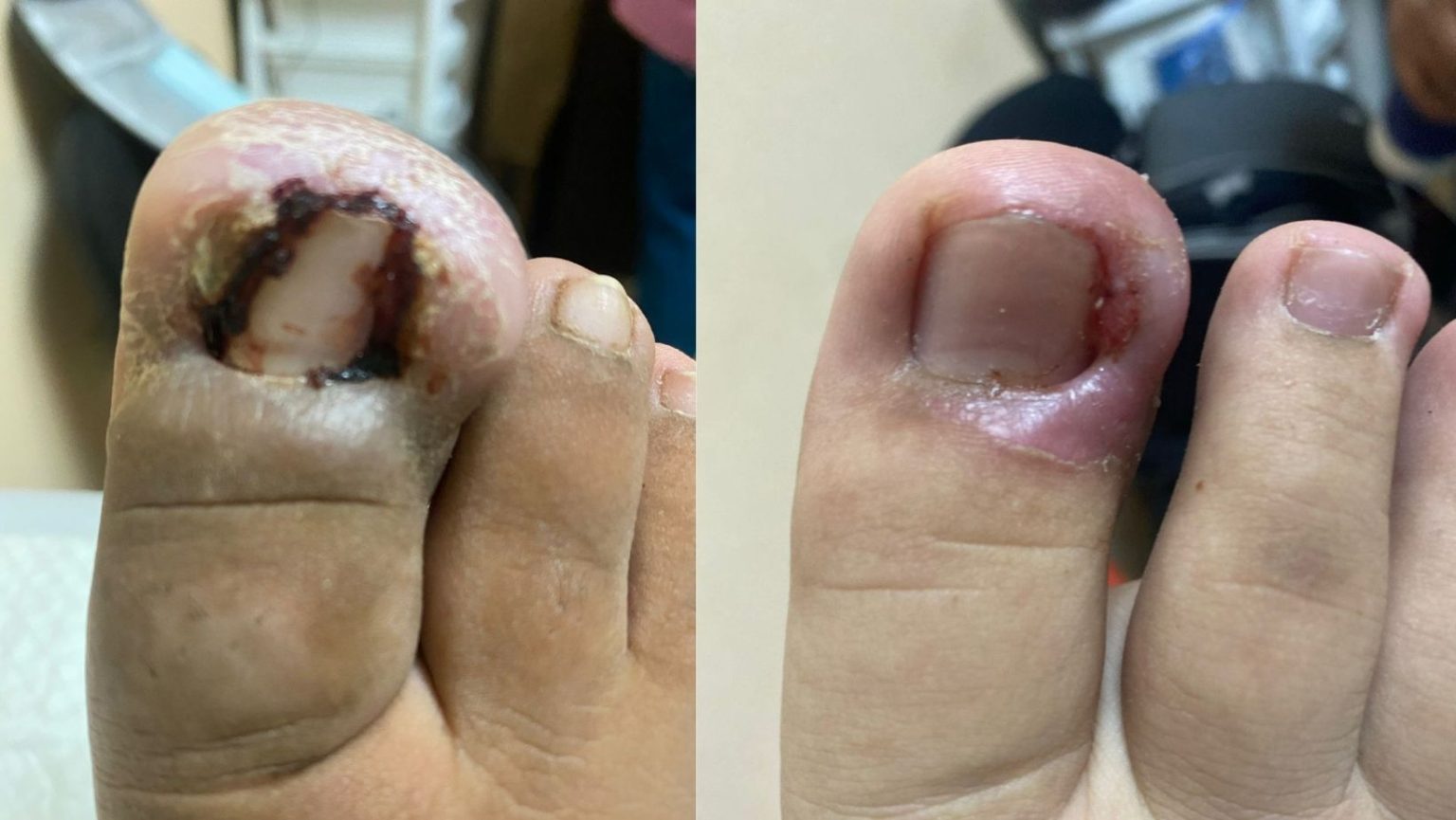 ¿Uñas encarnadas? Así tratamos las uñas encarnadas en Clínica Podal ...